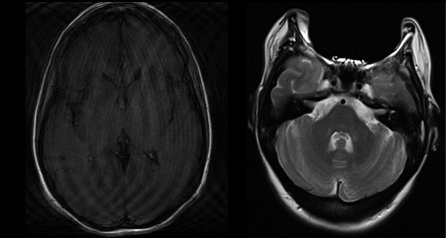 Magnetic Resonance Imaging in Huntington’s Disease | SpringerLink