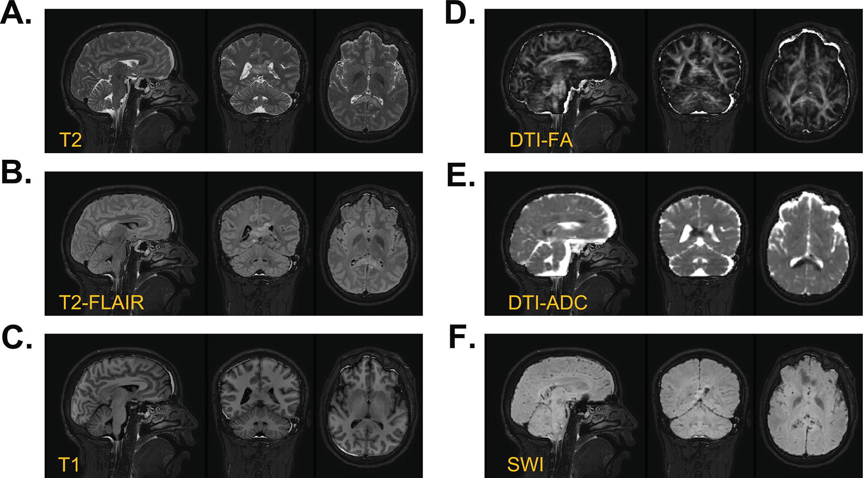 Advanced Neuroimaging Methods in Traumatic Brain Injury | SpringerLink