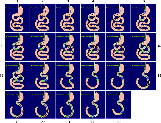 Double Balloon Enteroscopy | SpringerLink