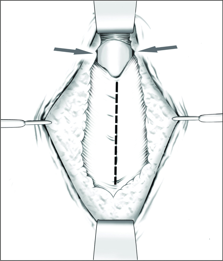 Stricture Excision and Primary Anastomosis for Anterior Urethral ...