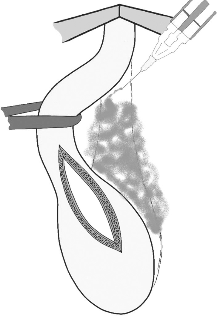 Buccal Mucosal Graft Urethroplasty | SpringerLink