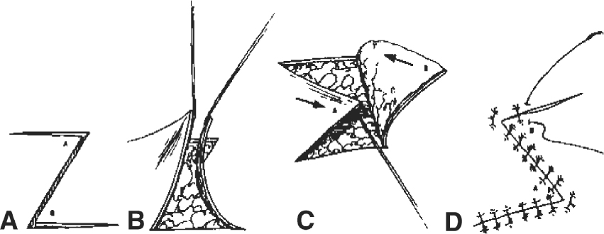 Techniques in Tissue Transfer: Plastic Surgery for the Urologist ...