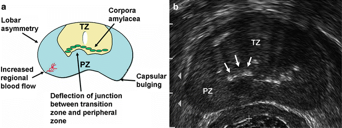 Transrectal Ultrasound of the Prostate | SpringerLink