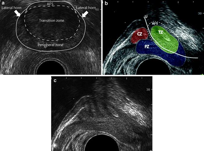 Transrectal Ultrasound of the Prostate | SpringerLink