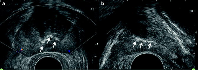 Transrectal Ultrasound of the Prostate | SpringerLink