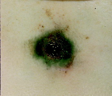 Gunshot Wound Deaths | SpringerLink