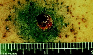 Gunshot Wound Deaths | SpringerLink