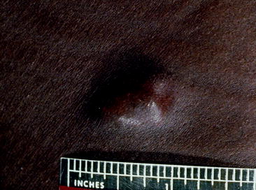 Gunshot Wound Deaths | SpringerLink