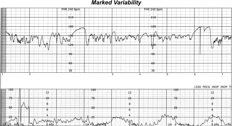 Monitoring Fetal Well-Being in the Critical Care Setting | SpringerLink