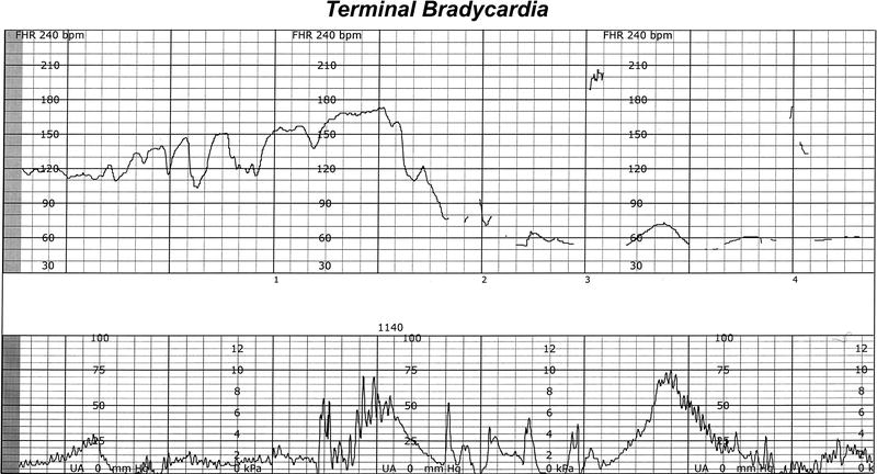 Prolonged Decelerations