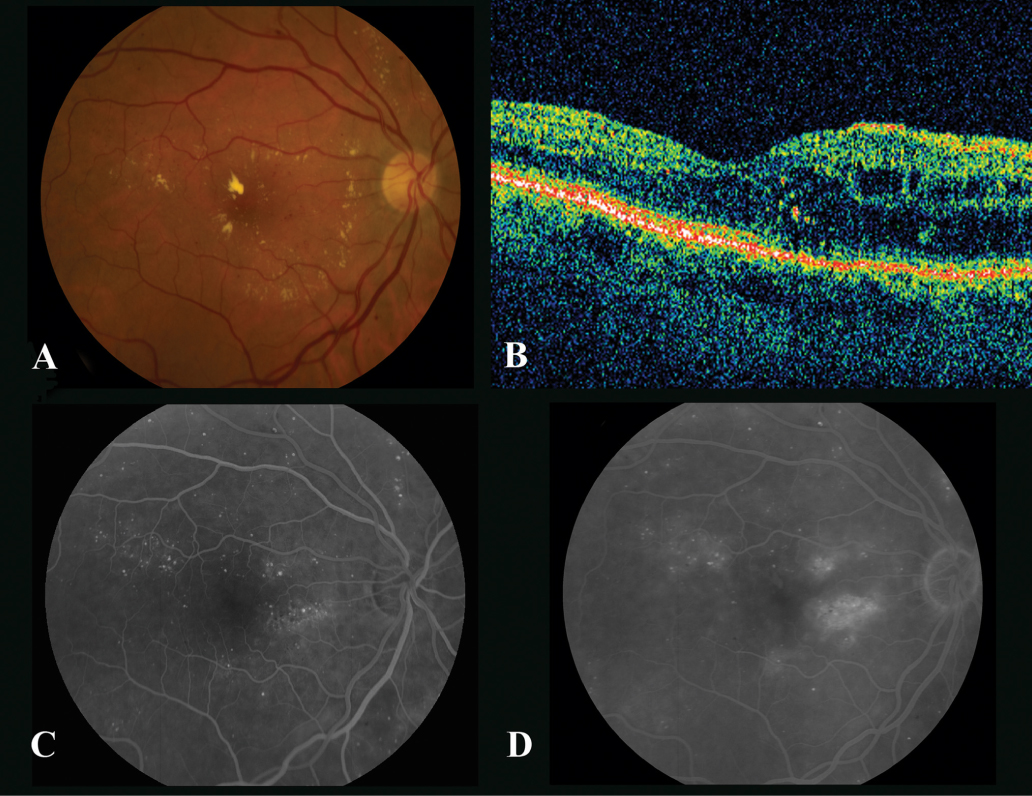 Nonproliferative Diabetic Retinopathy | SpringerLink