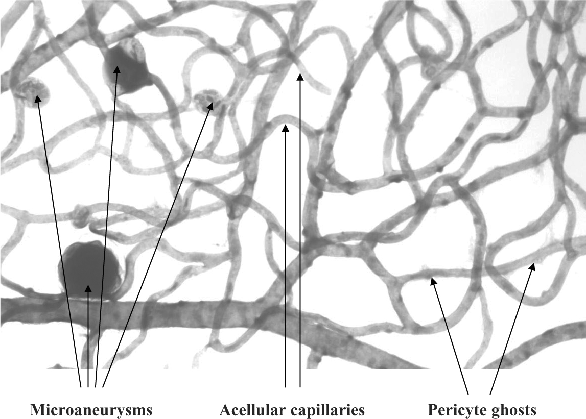 Capillary Dropout in Diabetic Retinopathy | SpringerLink