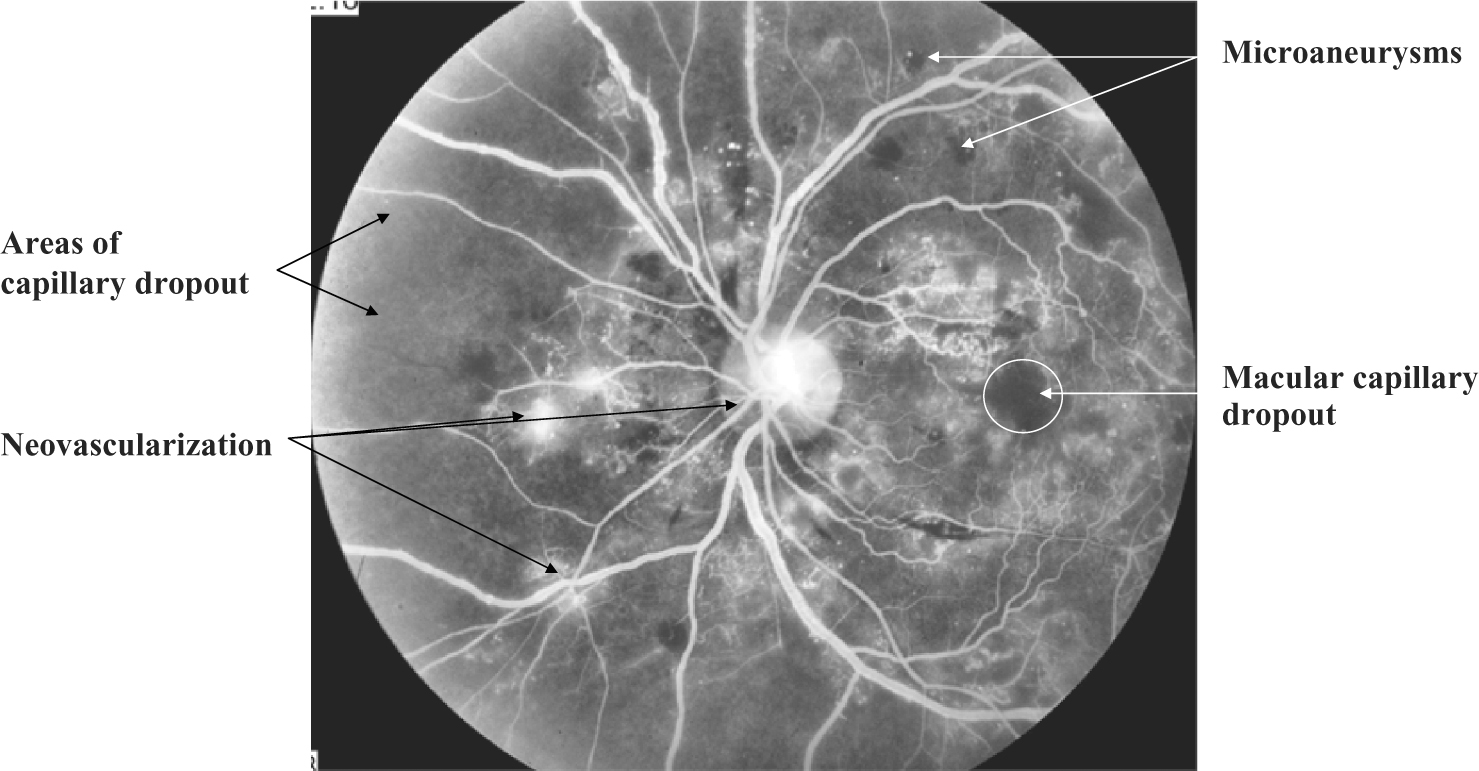 Capillary Dropout in Diabetic Retinopathy | SpringerLink