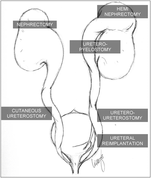 Ectopic Ureter | SpringerLink