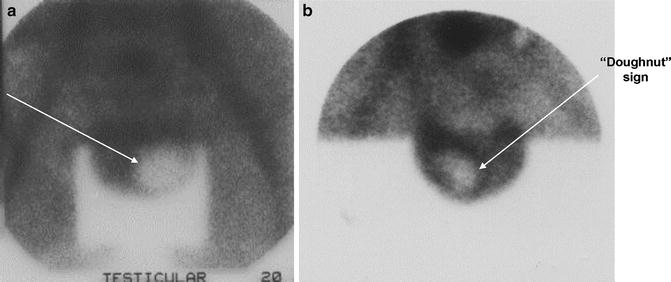Testicular Torsion | SpringerLink