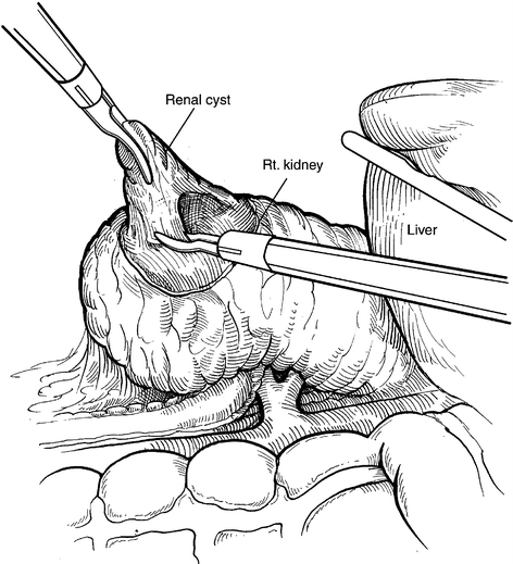 Laparoscopic Renal Cyst Decortication | SpringerLink
