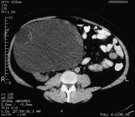 Laparoscopic Renal Cyst Decortication | SpringerLink