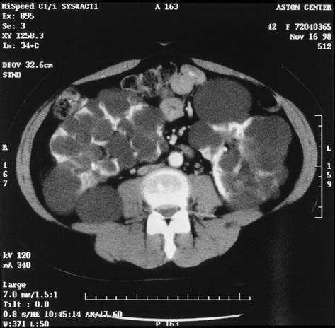 Laparoscopic Renal Cyst Decortication | SpringerLink