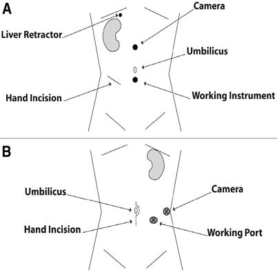 Laparoscopic Radical Nephrectomy | SpringerLink