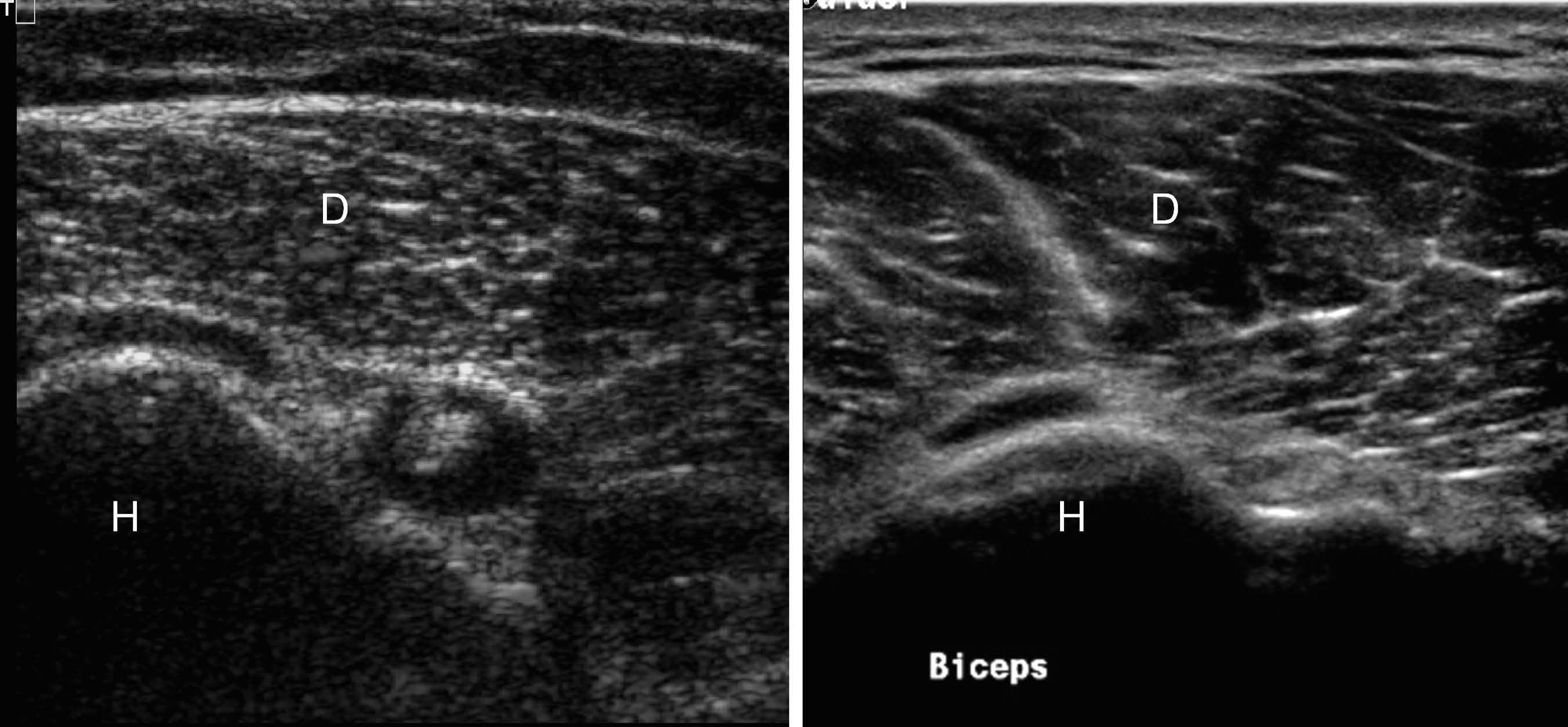 Ultrasound in the Evaluation of the Inflammatory Myopathies | SpringerLink