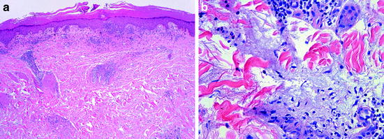 Interface Dermatitis | SpringerLink