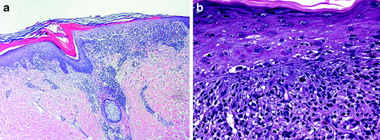 Interface Dermatitis | SpringerLink