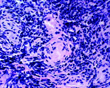 Perivascular Dermatitis | SpringerLink