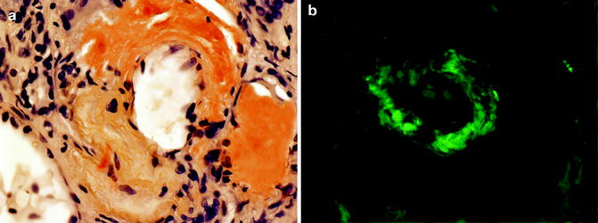 Thioflavin T Stain: An Easier and More Sensitive Method for Amyloid ...
