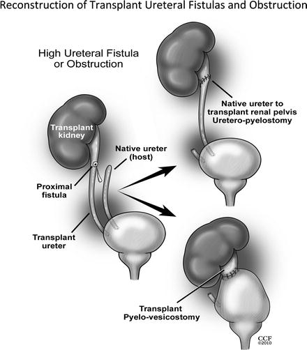 Surgical Complications after Kidney Transplantation | SpringerLink