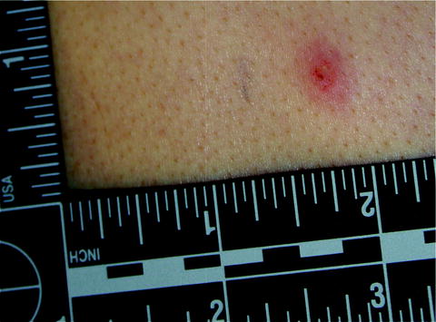 TASER ® Conducted Electrical Weapons | SpringerLink