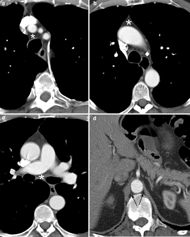 Normal Thoracic Anatomy and Common Variants | SpringerLink