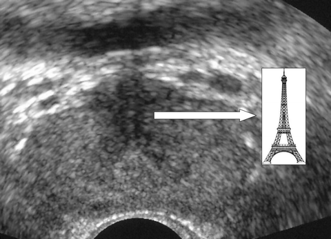 Principles of Prostate Ultrasound | SpringerLink