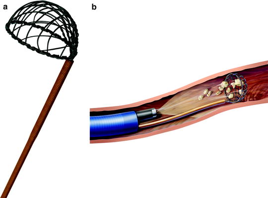 Stone Baskets and Forceps | SpringerLink