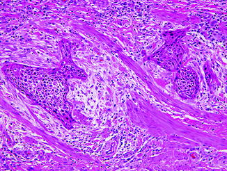 Pathology of Penile Cancer and Its Precursor Lesions | SpringerLink