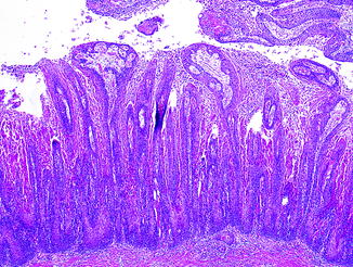 Pathology of Penile Cancer and Its Precursor Lesions | SpringerLink