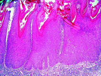 Pathology of Penile Cancer and Its Precursor Lesions | SpringerLink