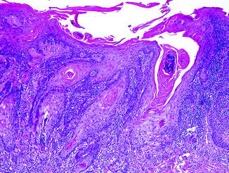 Pathology of Penile Cancer and Its Precursor Lesions | SpringerLink