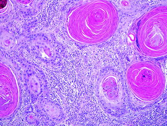 Pathology of Penile Cancer and Its Precursor Lesions | SpringerLink