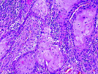 Pathology of Penile Cancer and Its Precursor Lesions | SpringerLink