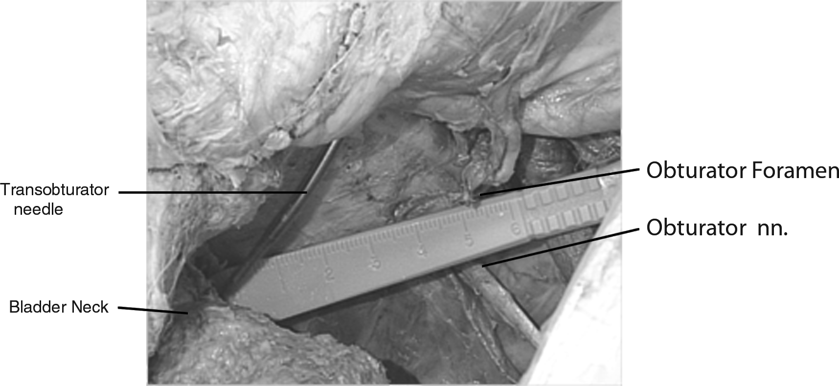 Pelvic Floor: Three-Dimensional Surgical Anatomy | SpringerLink