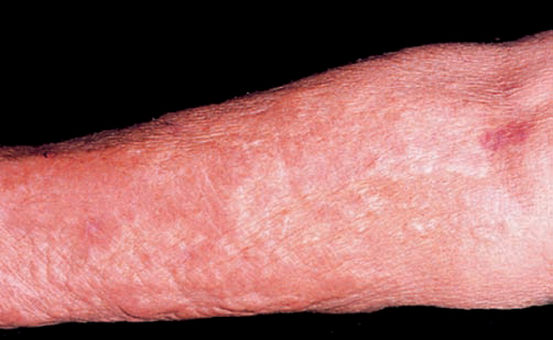 Nephrogenic Systemic Fibrosis and Other Scleroderma Mimickers ...