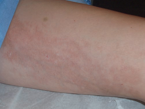 Nephrogenic Systemic Fibrosis and Other Scleroderma Mimickers ...