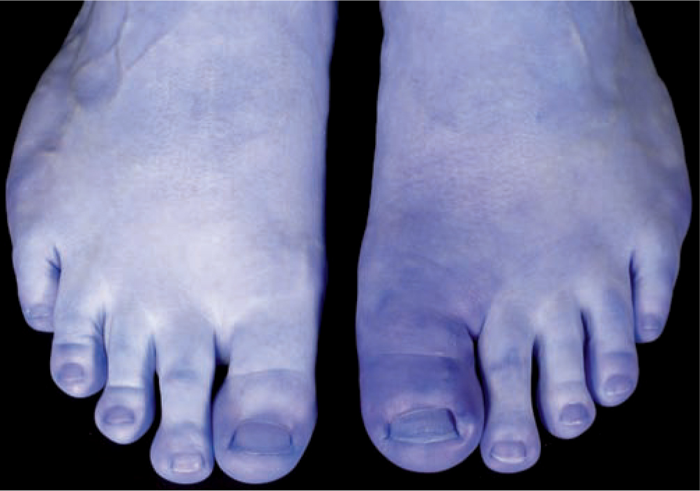 Rheumatoid Vasculitis | SpringerLink