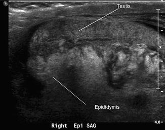 Disorders of Scrotal Contents: Orchitis, Epididymitis, Testicular ...