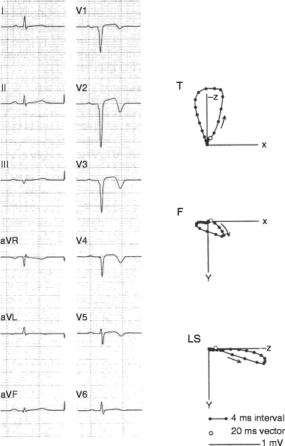 12 Lead Vectorcardiography | SpringerLink