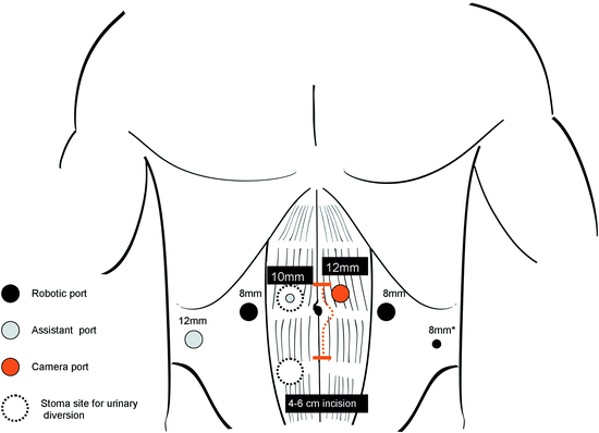 Port Placement in Robotic Urologic Surgery | SpringerLink