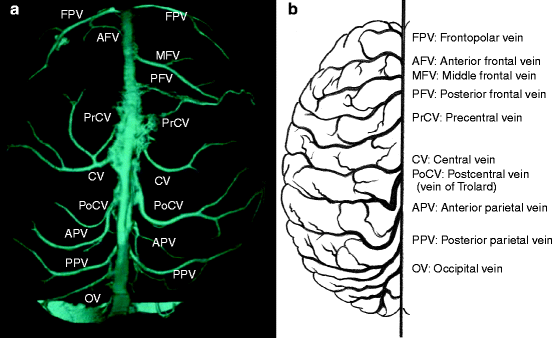 Normal Anatomy of Intracranial Veins: Demonstration with MR Angiography ...