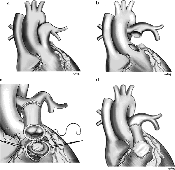 Truncus Arteriosus | SpringerLink