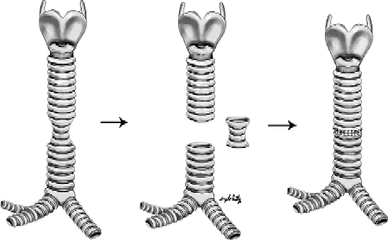 Tracheal Reconstruction | SpringerLink
