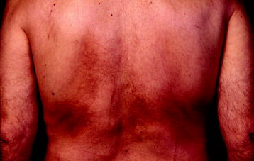 Localized Neuropathic Pruritus | SpringerLink